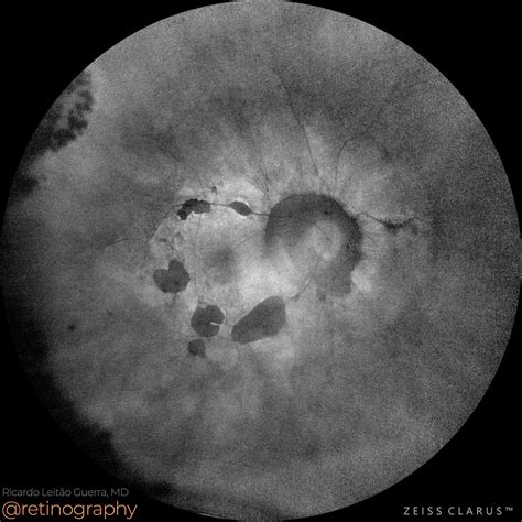 Pathologic Myopia Retinography