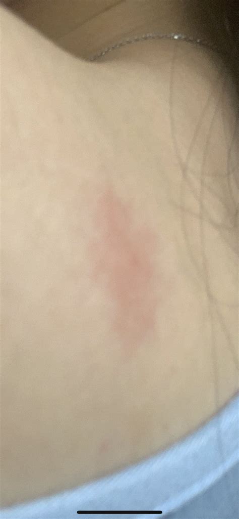 물린자국 진드기 지식in