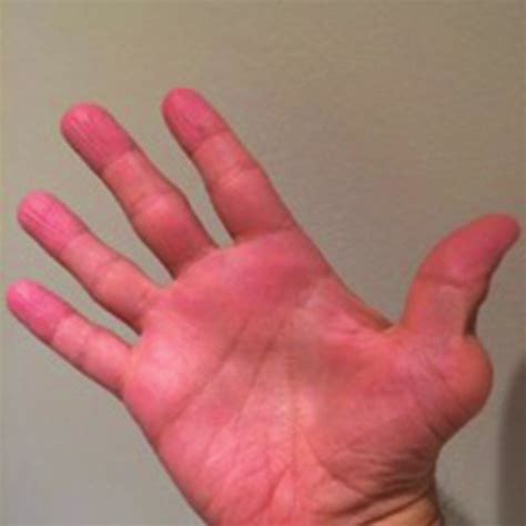 Photograph Of Right Hand Demonstrating Dislocation Of The MP Joint And Download Scientific