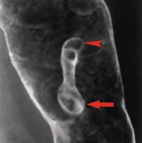 Colon And Appendix Radiology Key