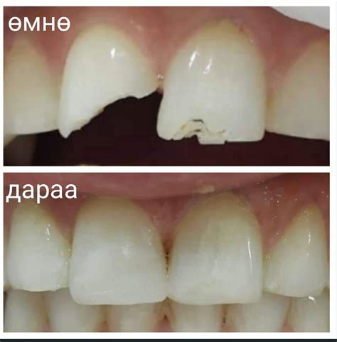 Цэгц Дент шүдний эмнэлэг Шүдний гэмтэл Таны шүд ямар нэгэн байдлаар хөнгөн гэмтсэн бол 🔹 аль