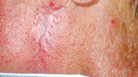 Nodular And Infiltrative Bcc On Cheek Erivedge® Vismodegib