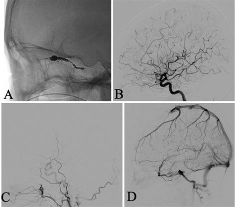 Transvenous Embolization Via The Facial Vein For Intraorbital Dural Arteriovenous Fistula