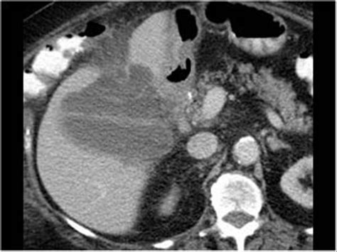 Abdomen And Retroperitoneum 12 Gallbladder And Bile Ducts Case 12