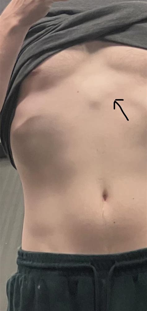 Lump Or Mass Next To Xiphoid Process Tender R Medical Advice