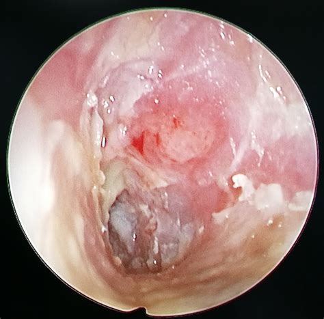Otitis Externa Tympanic Membrane Managing Chronic Otitis Externa