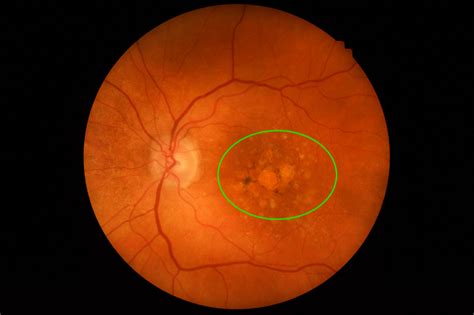 Stages Of Age Related Macular Degeneration Macular Disease Foundation