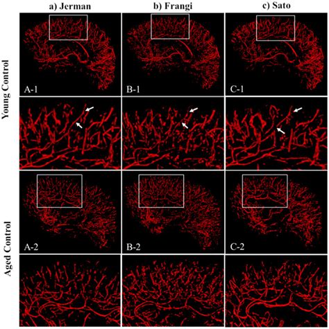 Performance Comparison Of Hessian Based Methods For Small Cerebral