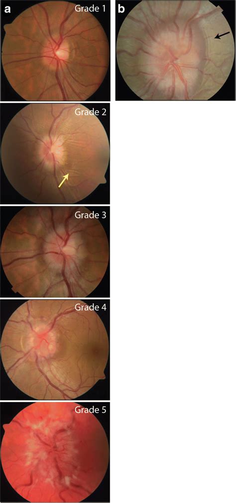 Fundoscopic Examples Of The Frisén Papilledema Grading Scale A Grade Download Scientific