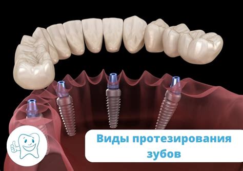 Преимущества и недостатки различных видов протезирования зубов ...