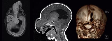 Frontoethmoidal Encephalocele Report Of A Case Neurocirugía English Edition