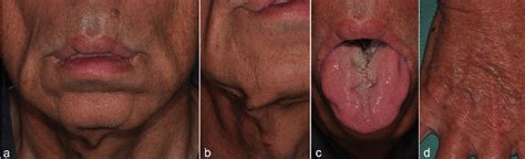 Clinical Features Of The Patient A Characteristic Sagging Cheeks And Download Scientific