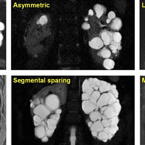 Illustrations Of Atypical Imaging Patterns These Include Unilateral Download Scientific