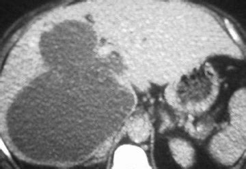Imaging Of Cystic Liver Lesions In The Adult Applied Radiology