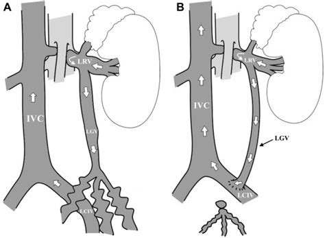 Current Results Of Left Gonadal Vein Transposition To Treat Nutcracker