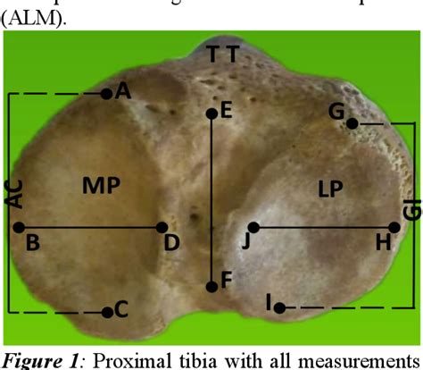 Figure From Morphometric Anatomy Of The Tibia Plateau In Nigerians Semantic Scholar