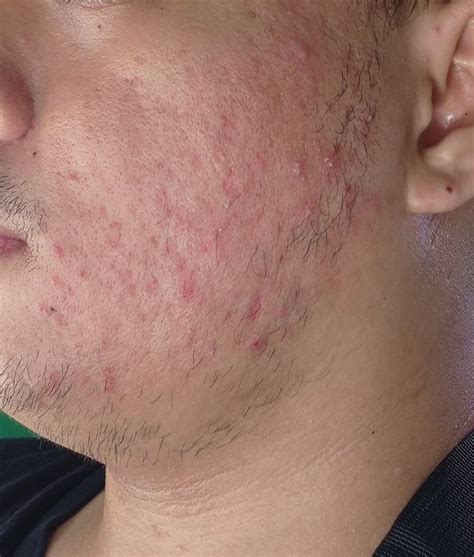 Doxycycline R Acne