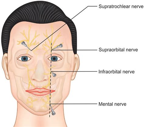 Supratrochlear Nerve Block