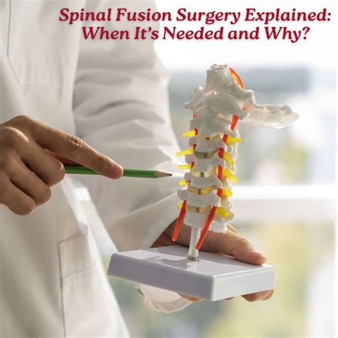 Spinal Fusion Surgery Explained When Its Needed And Why Spine And