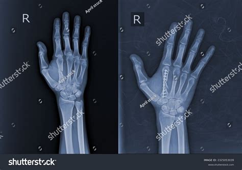 X Ray Showing Plate Fixation 2th Metacarpal Stock Illustration 2325053039 Shutterstock