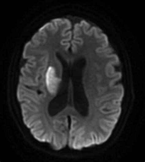Diffusion Weighted Image Dwi Magnetic Resonance Imaging Sequence