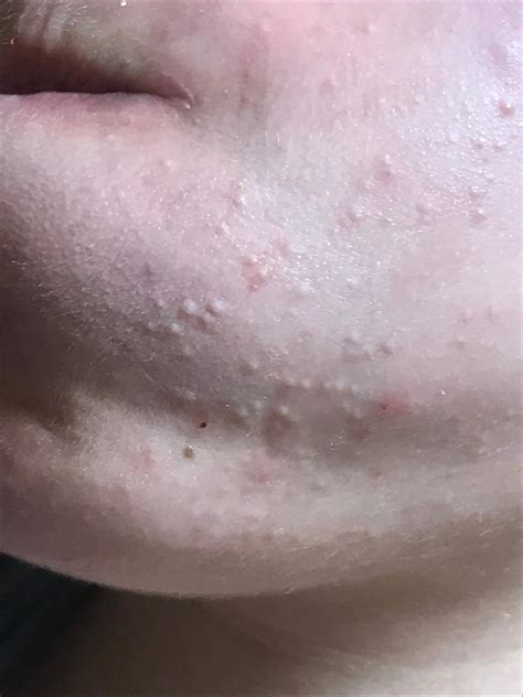 Kleine Weiße Pickel Milien Entfernen And Vorbeugen Hebamme Fz