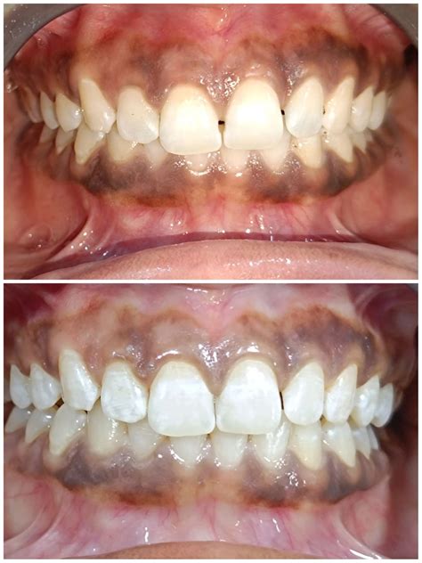 Dr Abdul Khaliq On Linkedin Class 3 Composite Restoration