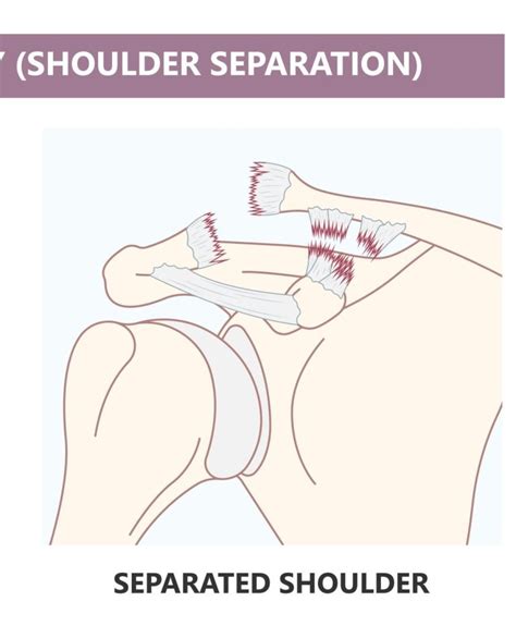 Acromioclavicular Joint Separation Physioflow Pt Physical Therapy Vancouver Wa