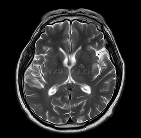 Mri Brain Scan Axial T2w For Detect Brain Diseases Sush As Stroke
