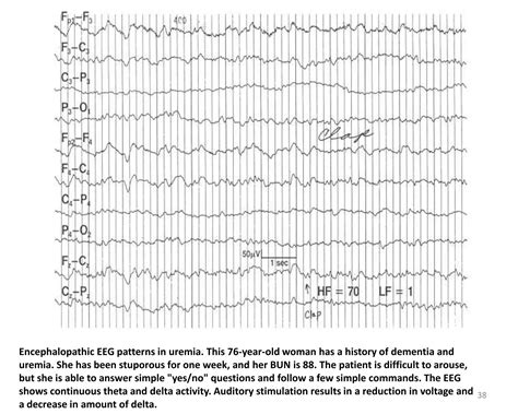 Eeg Encefalopati Pptx