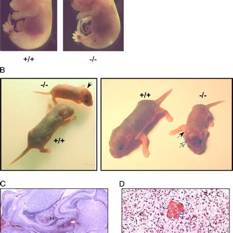 Neural Tube Developmental Defects And Cerebral Infarctions In