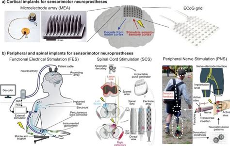 Neuroprosthetics From Sensorimotor To Cognitive Disorders R Transhumanism
