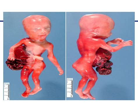 Abnormalities Of Placenta And Cordppt Ppt