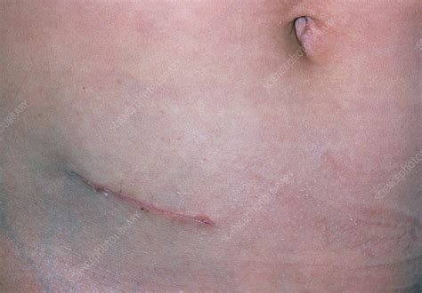 Open Appendectomy Scar Any Advice For Surgery Scar