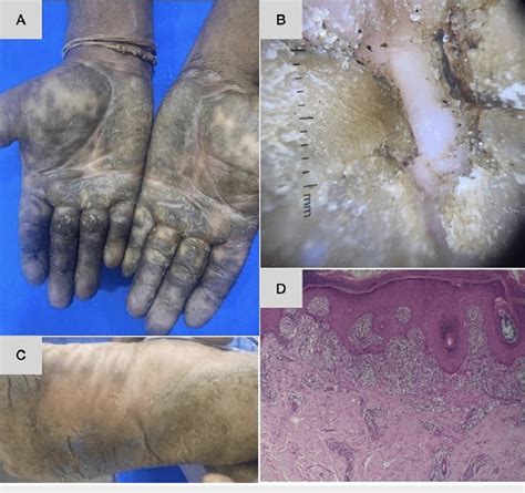 A Case Of Palmoplantar Lichen Planus Involving Both Hands And Feet And