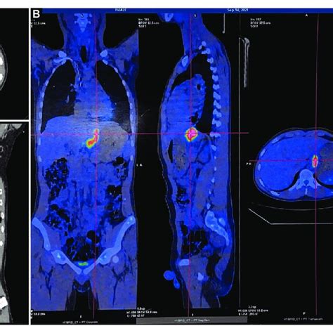 A Y B Imagen Tumoral Vista Por Estudios De Extensión Tomografía