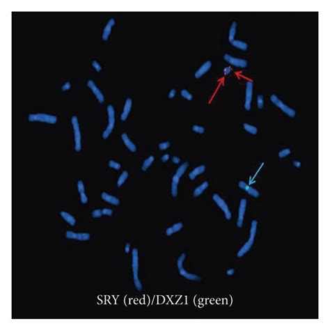 G Banding Karyotype A B Combined With Fish C D Of The Young