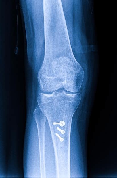 Premium Photo Xray Knee Joint Fracture Proximal Tibia And Post Fix Fracture Proximal Tibia