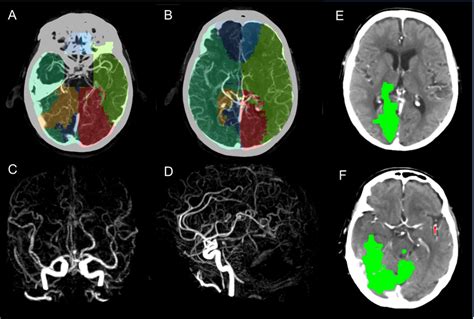 Right Pca Occlusion Occluded Pre Communicating Segment P1 Of The