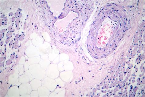 skeletal muscle atrophy photomicrograph showing decreased fiber size