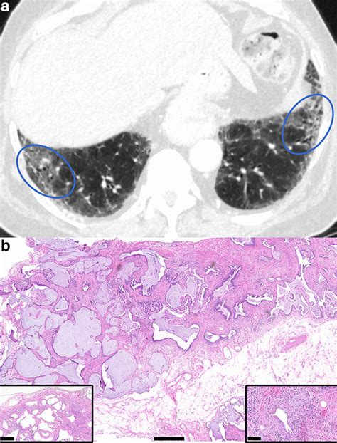 Ct Probable Uip With Corresponding Histopathology Uip A Thin Slice Ct