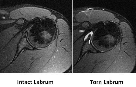 Shoulder Labral Repair