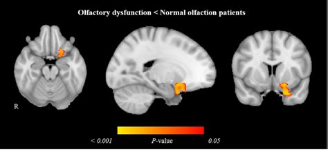 Gray Matter Volume Reduction In Olfactory Dysfunction Patients Compared Download Scientific