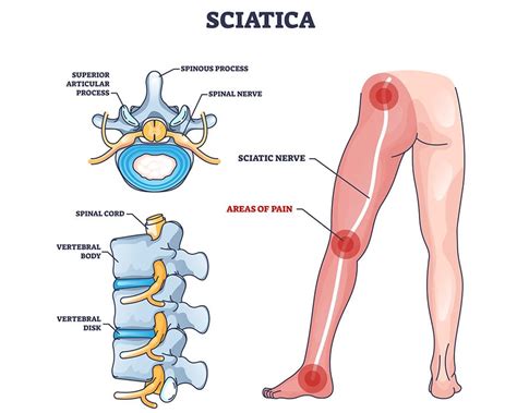 Sciatica Nerve