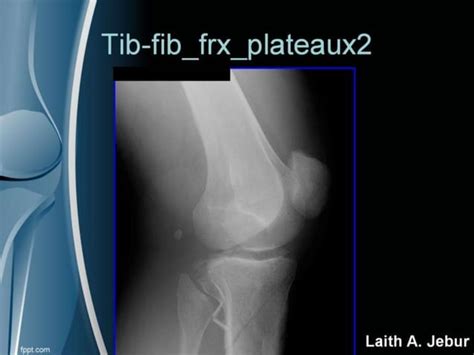 Orthopedics Of Tibia Fibula PPT
