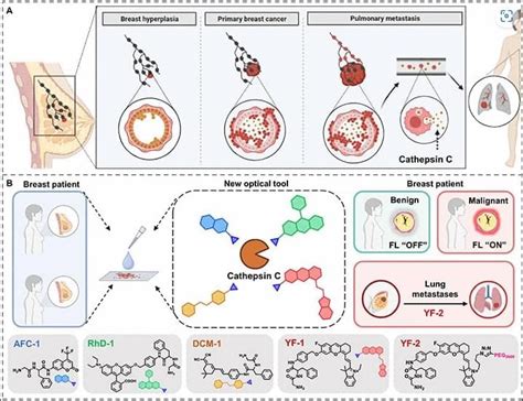 Rapid Sorting And Auxiliary Evaluation Of Malignant Breast Tumors By