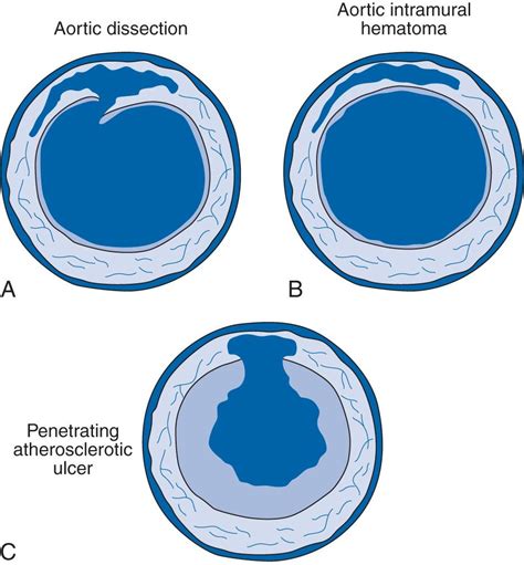 Aortic Dissection Clinical Tree