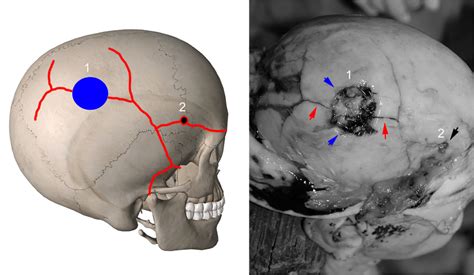 Case 2 In The Right Temporal And Parietal Bone A Linear Cranial