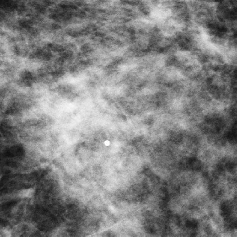 Patient 2 Pleomorphic Calcifications Well Circumscribed Calcification Download Scientific