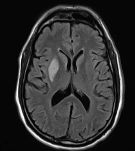 Mri Brain Showed Foci Of Acute Ischemia In The Right Caudate Nucleus Download Scientific